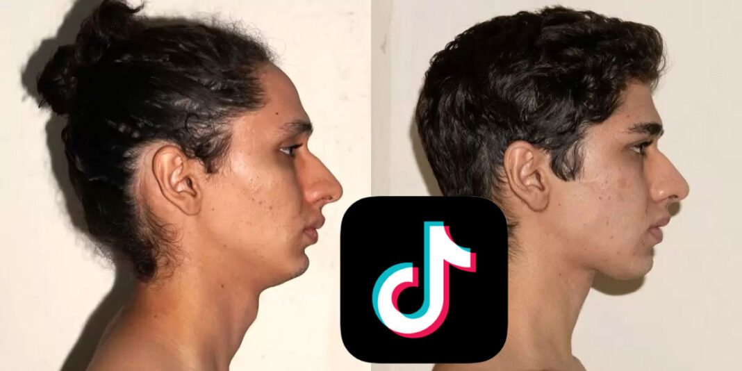 Qué significa Mewing: el meme de TikTok que ha llegado muy lejos